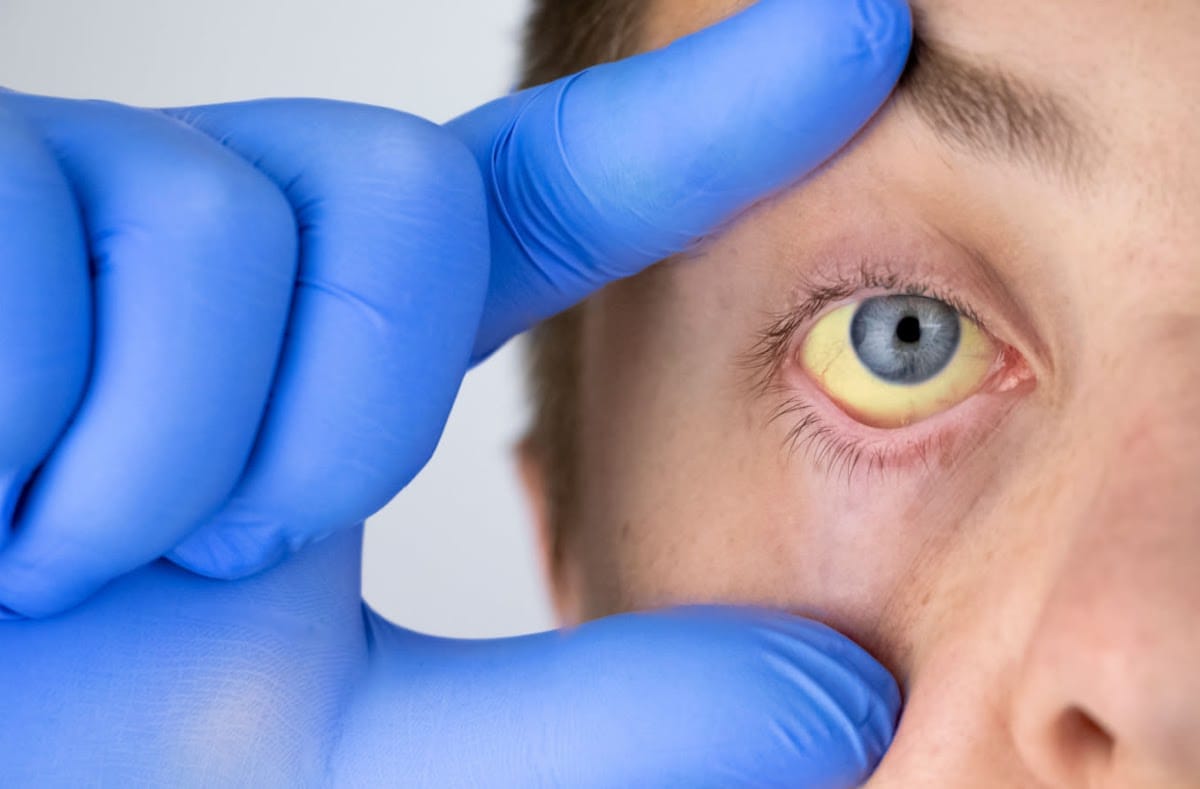 How Iron Deficiency Affects Your Eyes and Vision Quality